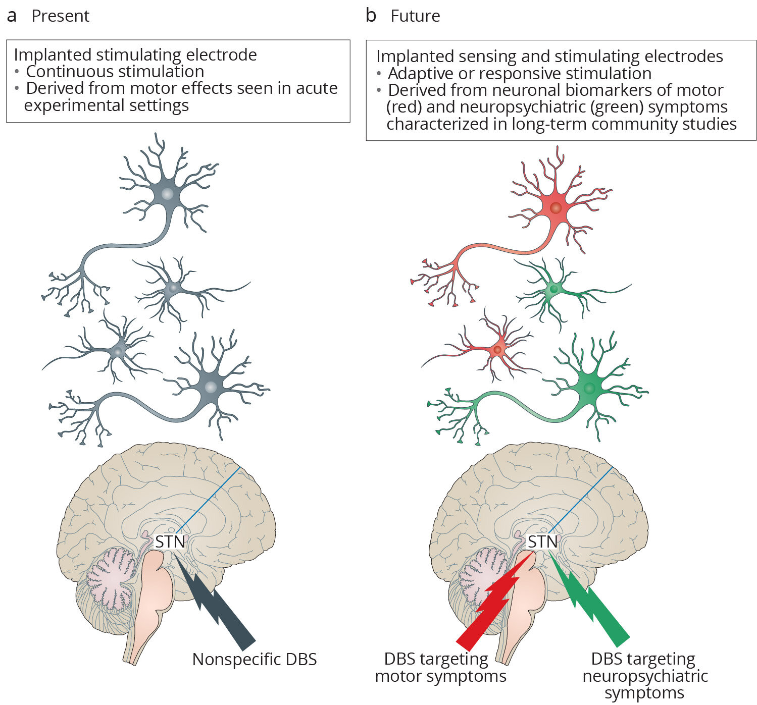 Our Parkinson's Place: Advances in deep brain stimulation could lead to ...