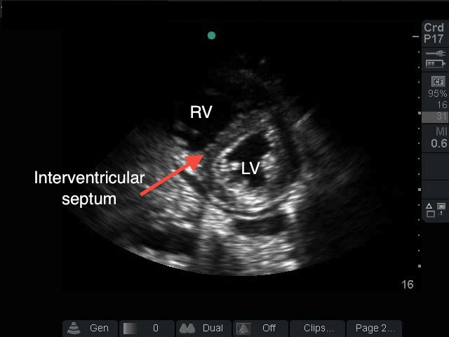 Emory Emergency Ultrasound: Right Heart Strain