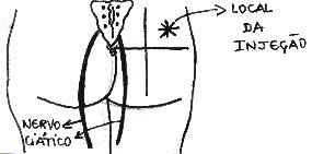 Enfermagem - 7ª Fase ESUCRI: Injeção Instramuscular