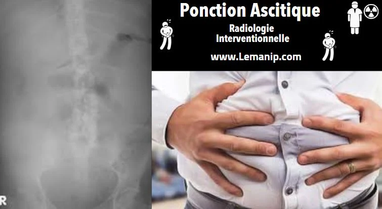 Ponction Ascitique Radiologie Interventionnelle