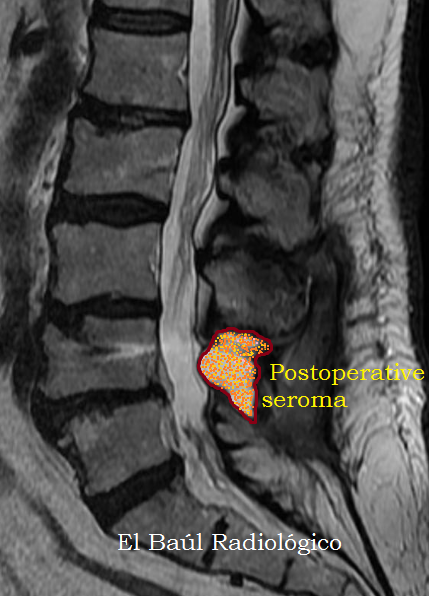El Baúl Radiológico: SEROMAS POSTQUIRÚRGICOS PARAVERTEBRALES (Lumbar ...
