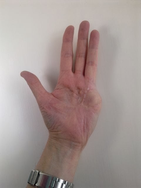 Hand rehabilitation experience with Dupuytren's contracture ...