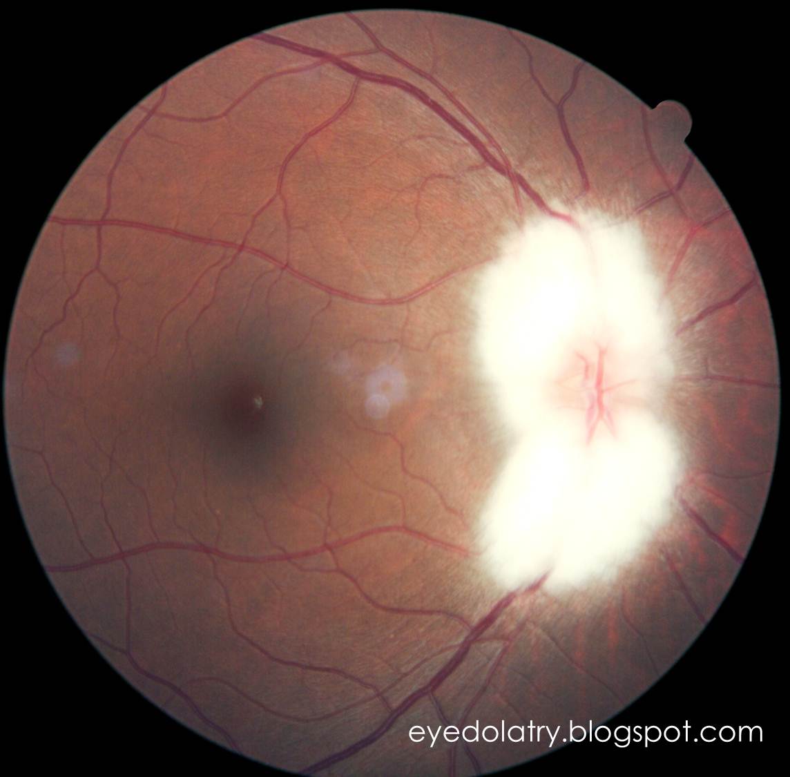 Myelinated retinal nerve fiber layer - perybanking