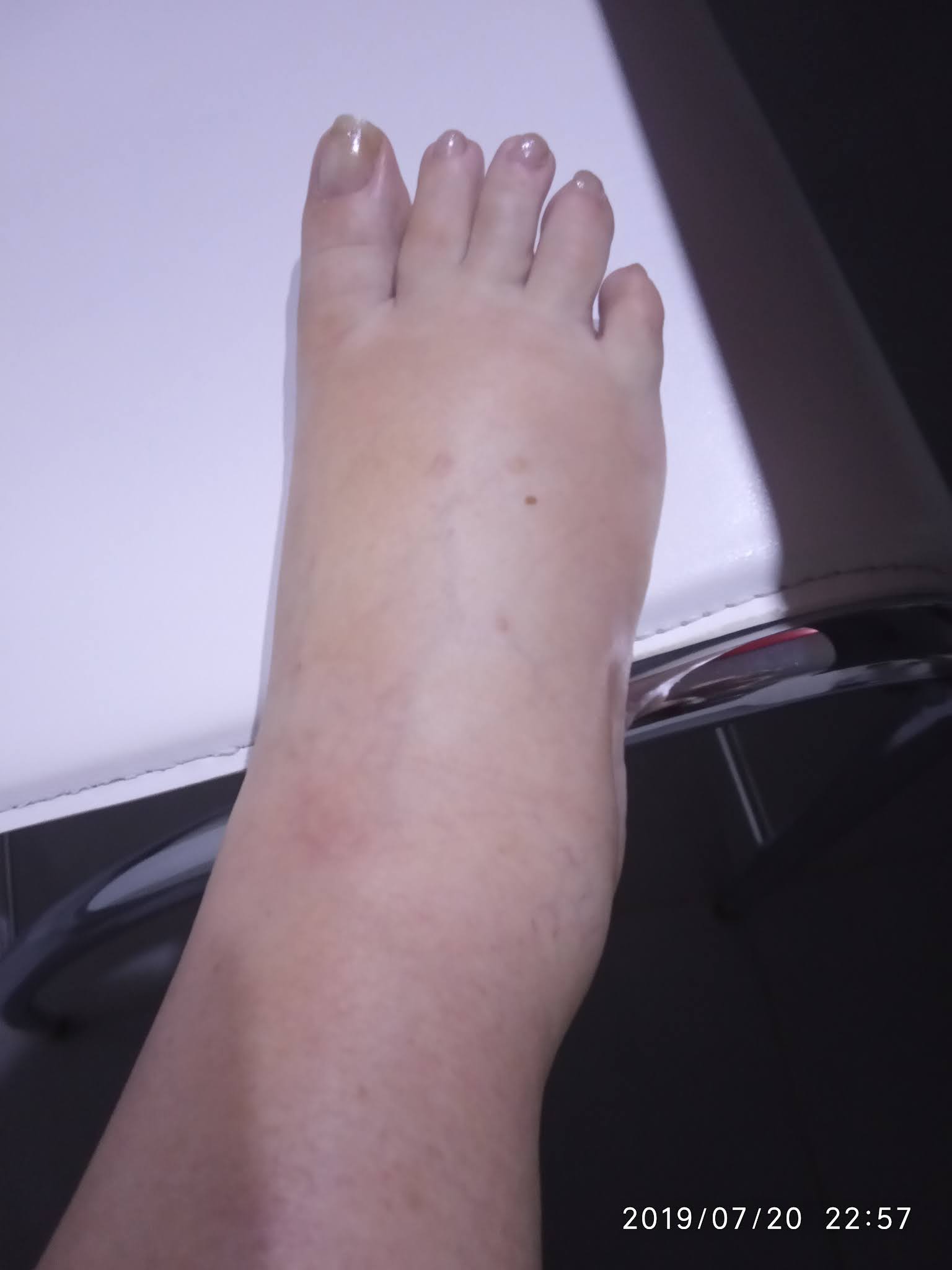 LA MALADIE DE BASEDOW