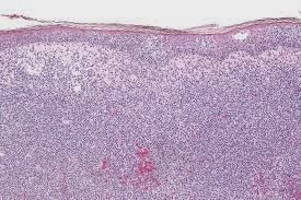 Cutaneous T-cell lymphoma (CTCL) | CanCer-666