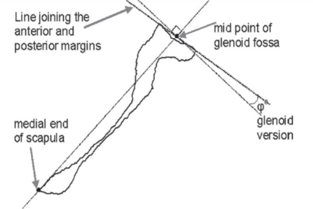 Shoulder and Elbow Surgery: Shoulder arthroplasty for osteoarthritis in ...
