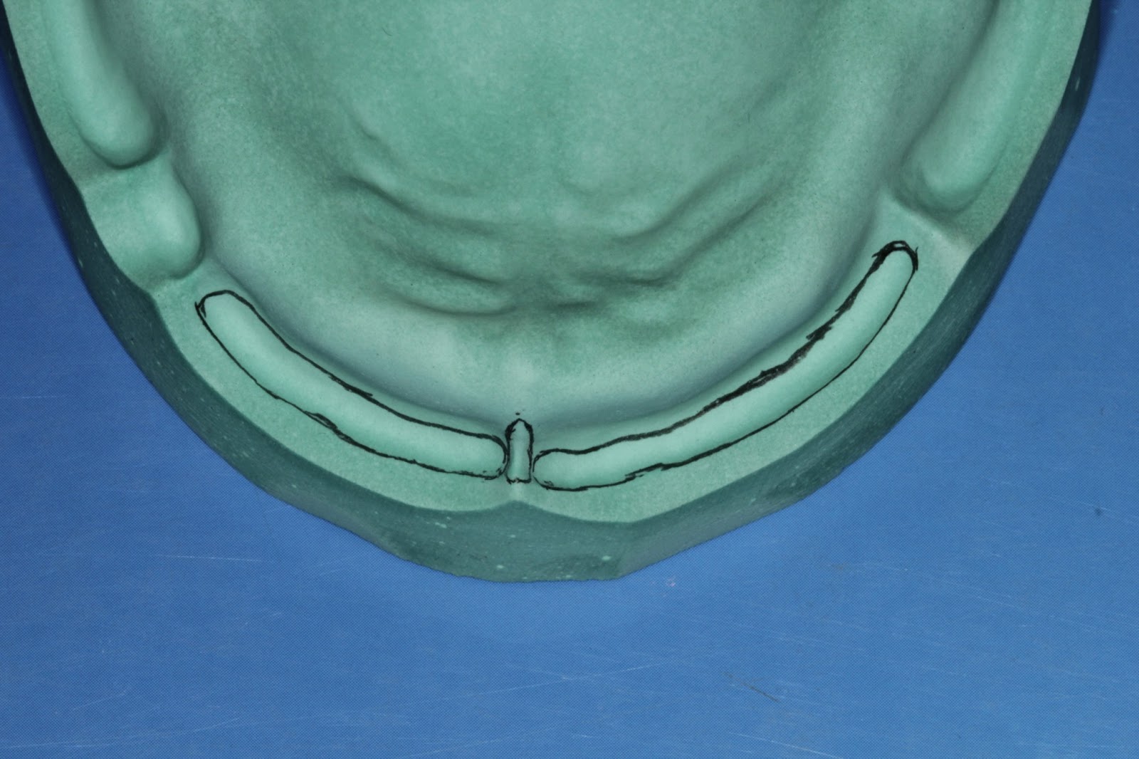 Understanding Prosthodontics - Tagore Dental College & Hospital-By ...