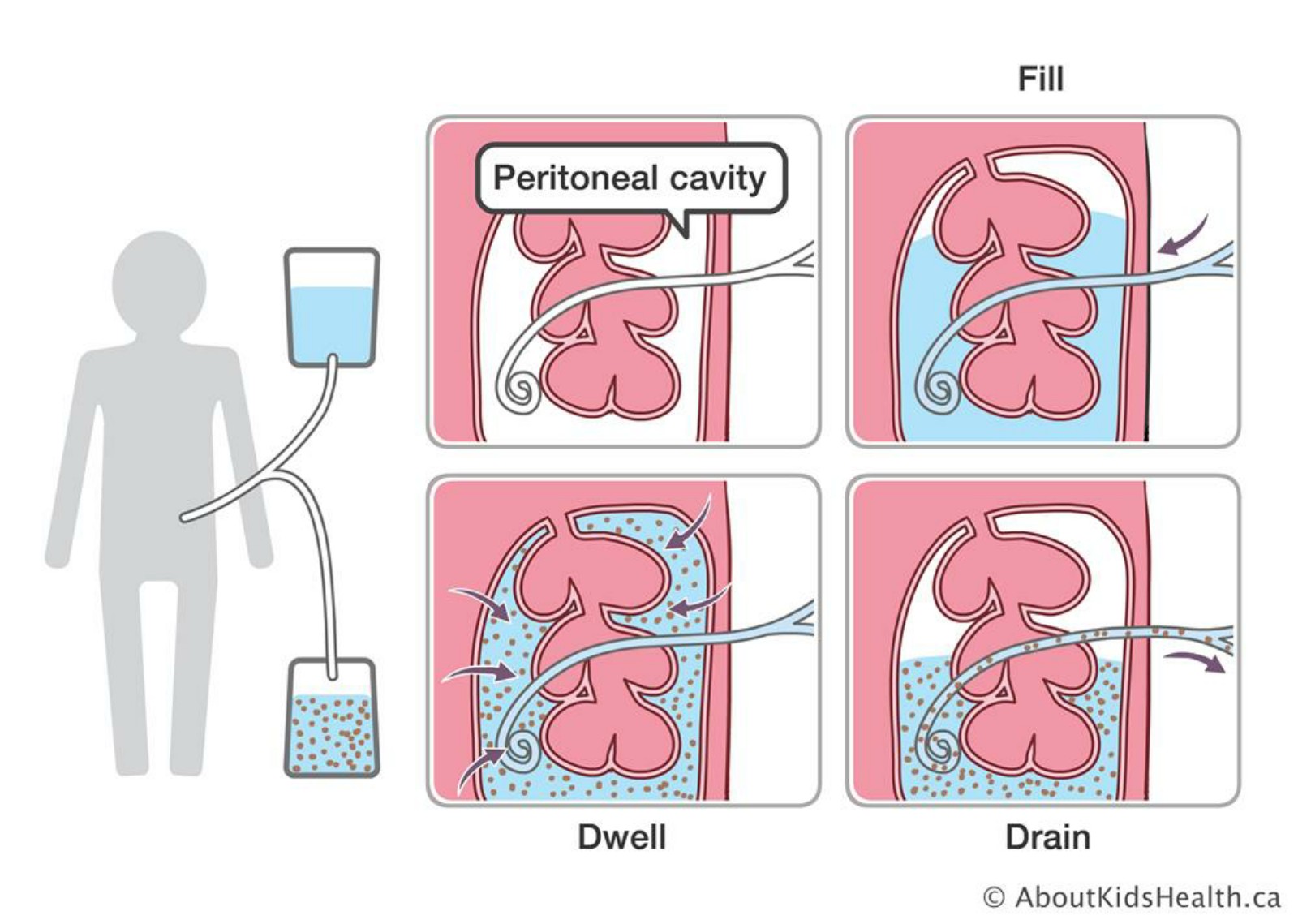 Rawatan Dialisis: Antara Fistula dan CAPD??? | NaSa