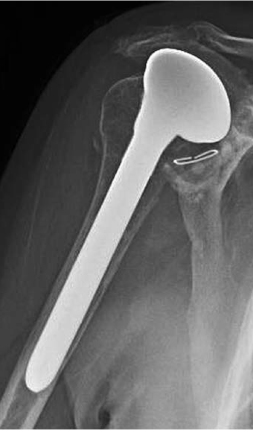 UW Shoulder and Elbow Academy: The importance of the humeral osteotomy ...