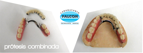 Laboratorio Dental Martin Falcon: protesis combinada