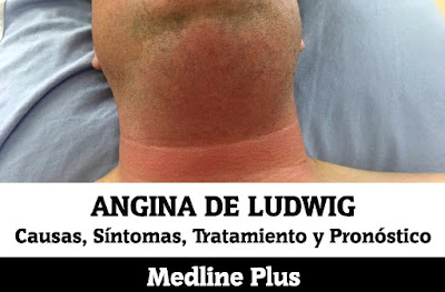 ANGINA DE LUDWIG: Causas, síntomas, tratamiento y pronóstico