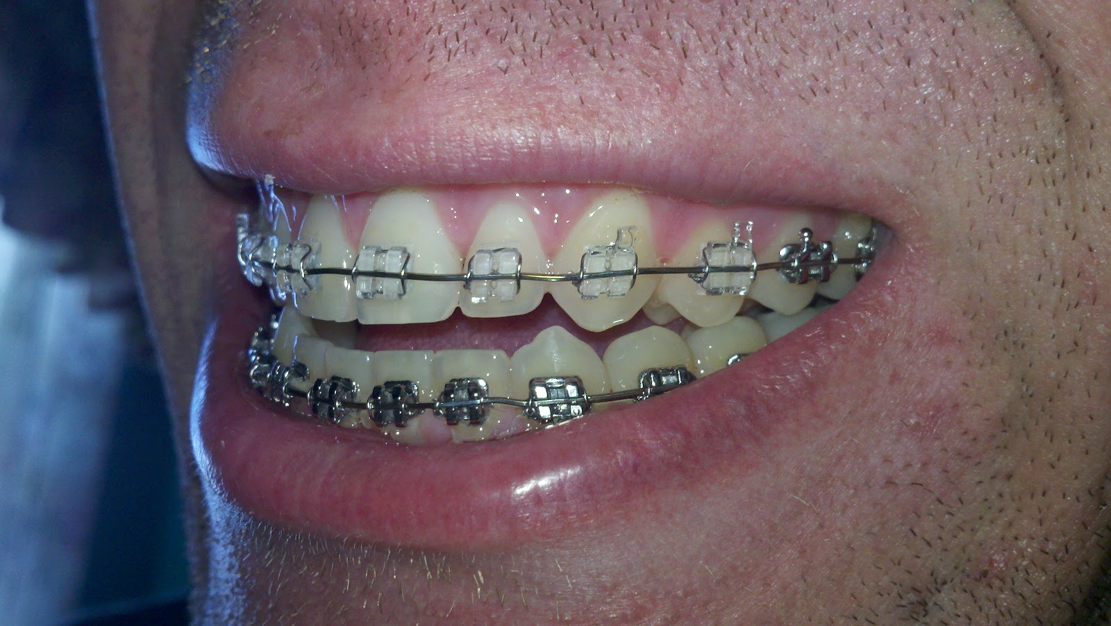 Braces/Open Bite Surgery: FINALLY Sure Smile Wires are in!