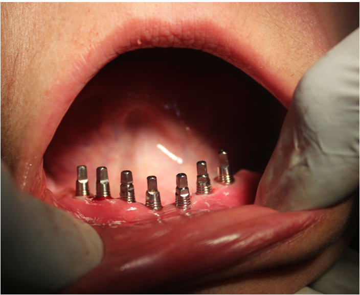 Best Dental implant clinic in chennai: BASAL IMPLANTS FOR FULL MOUTH ...