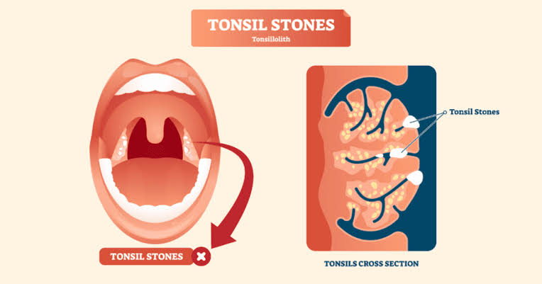 Everything you need to know about tonsil stones- symptoms & treatment