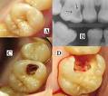 CLINICA ANTICARIES: CARIES RAMPANTE