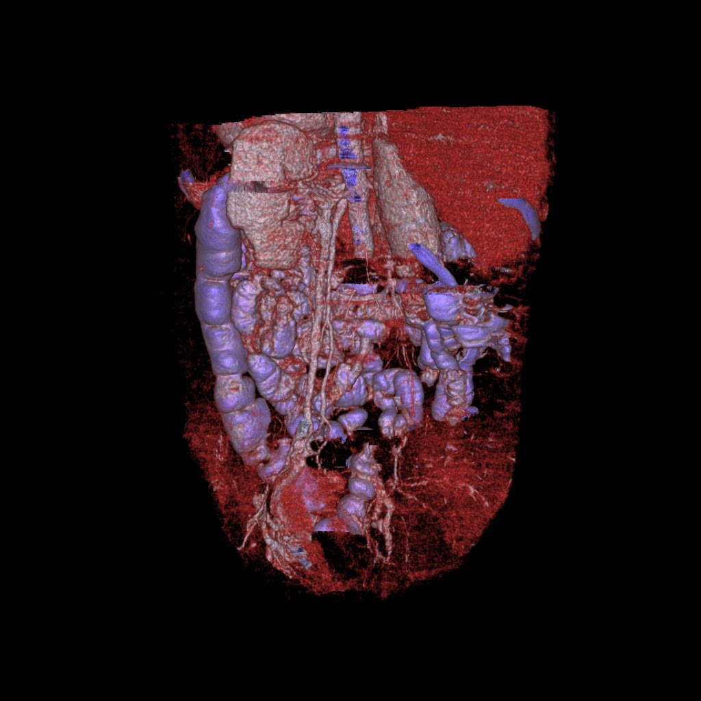 Radshare: OVARIAN VEIN REFLUX WITH PELVIC VARICES