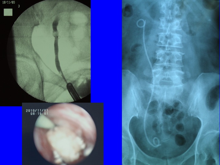 Kuching Urology古晉秘尿專科: Urolithiasis edited for UNIMAS 9 April 2018 by ...