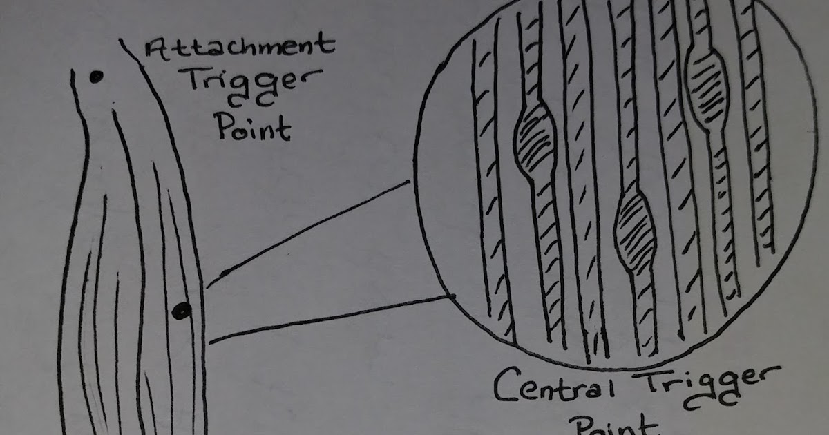 Self Trigger Point Therapy: What Are Trigger Points?