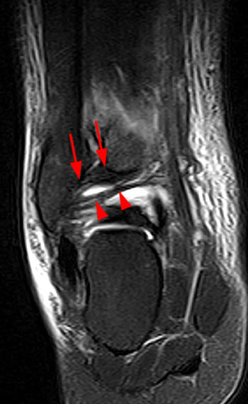 MRI Musculo-Skeletal Section: High ankle sprains.
