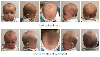 Understanding Flat Head Syndrome (Plagiocephaly) in Babies - Healthy ...