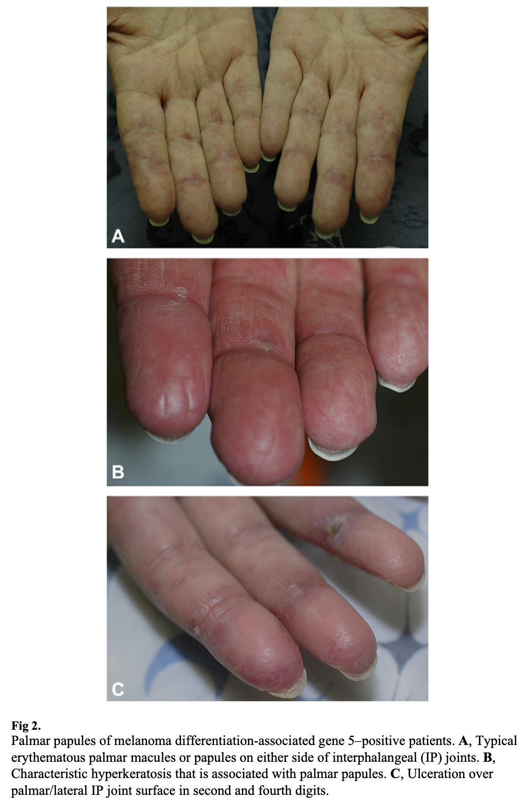 Hospitalist ~なんでも無い科医の勉強ノート~: 逆ゴットロン徴候: Inverse Gottron's sign/papule
