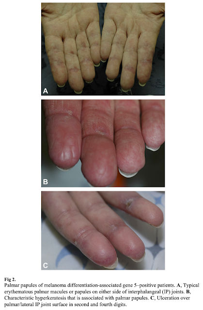 Hospitalist ~なんでも無い科医の勉強ノート~: 逆ゴットロン徴候: Inverse Gottron's sign/papule