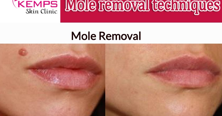 What are the moles? | KEMPS Skin Clinic