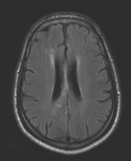 Corpus Callosum Infarction-MRI - Sumer's Radiology Blog