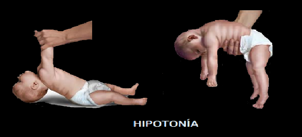 Tratamiento de la hipotonía Blog Atendiendo Necesidades