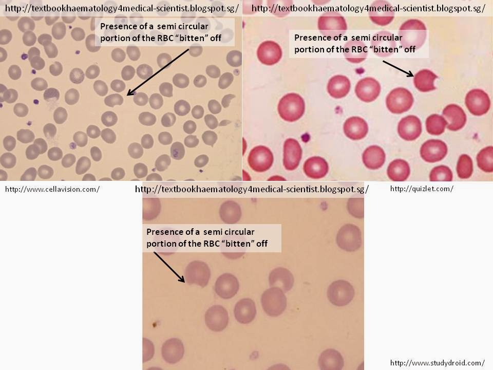 Heinz Bodies And Bite Cells