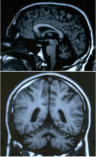 Ataxia Y Atáxicos Ataxia Un Proceso Degenerativo Que Afecta Unos 8