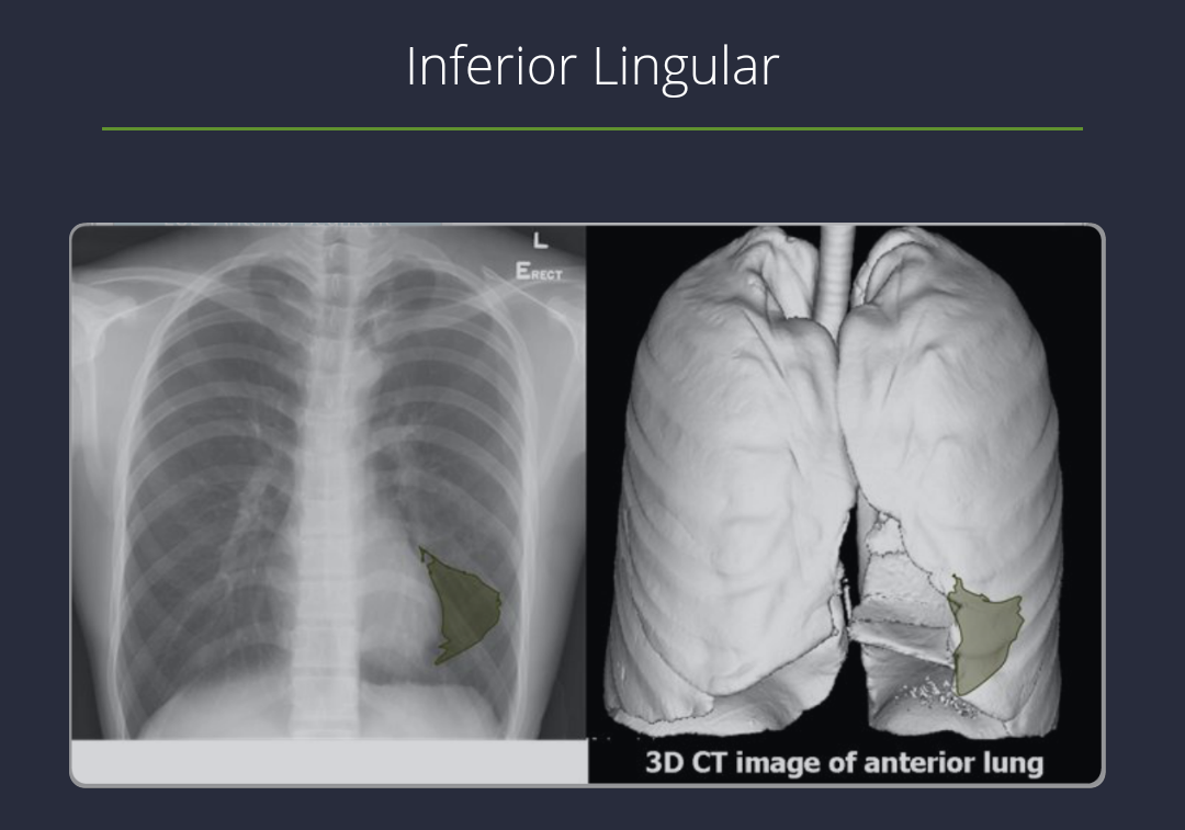 Medicowesome: Chest x-ray - Left Lung.