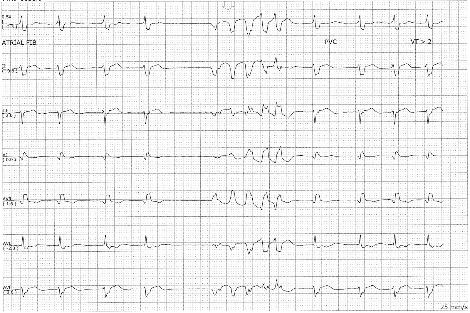Atrial Fibrillation with a Short Run of Polymorphic VT