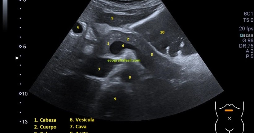 ZONA DE SALUD DE OFRA: Ecografía fácil. Cola de Páncreas. Técnica del ...