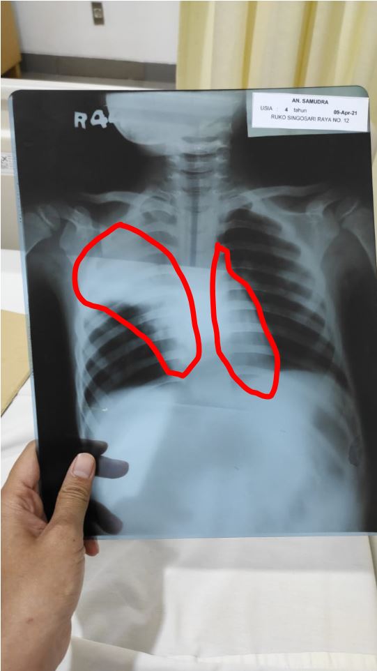 Membaca Hasil Rontgen Anak | GAROBLOGZ - Ghani Rozaqi on the Blog