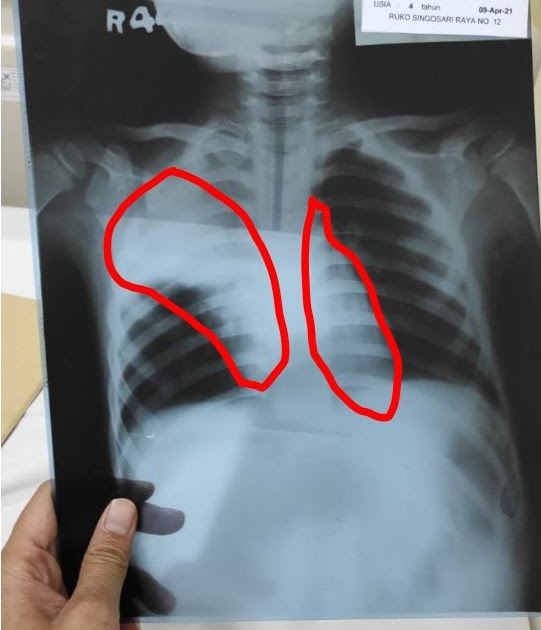 Membaca Hasil Rontgen Anak | GAROBLOGZ - Ghani Rozaqi on the Blog