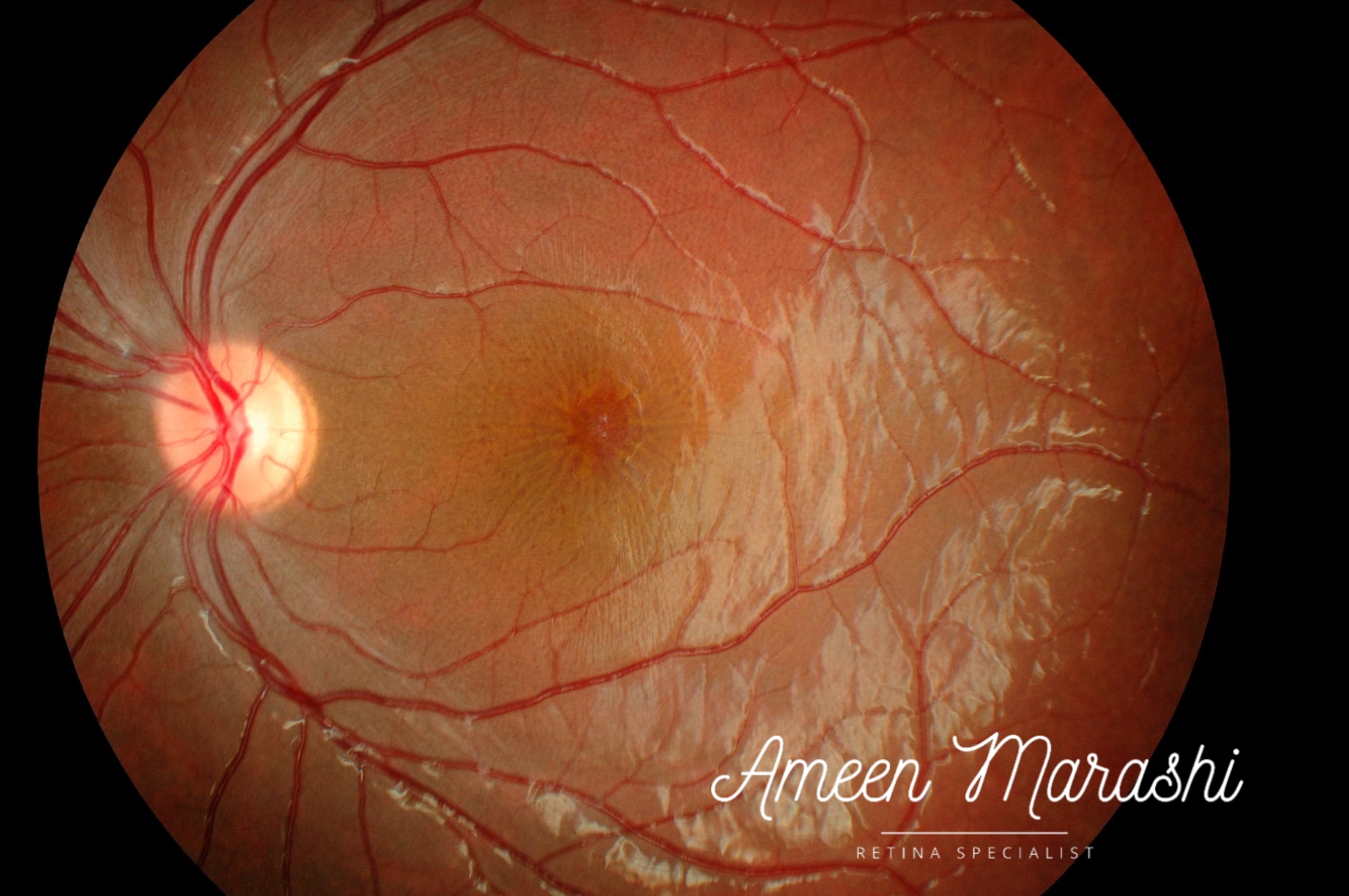 X-linked juvenile retinoschisis (XLRS)