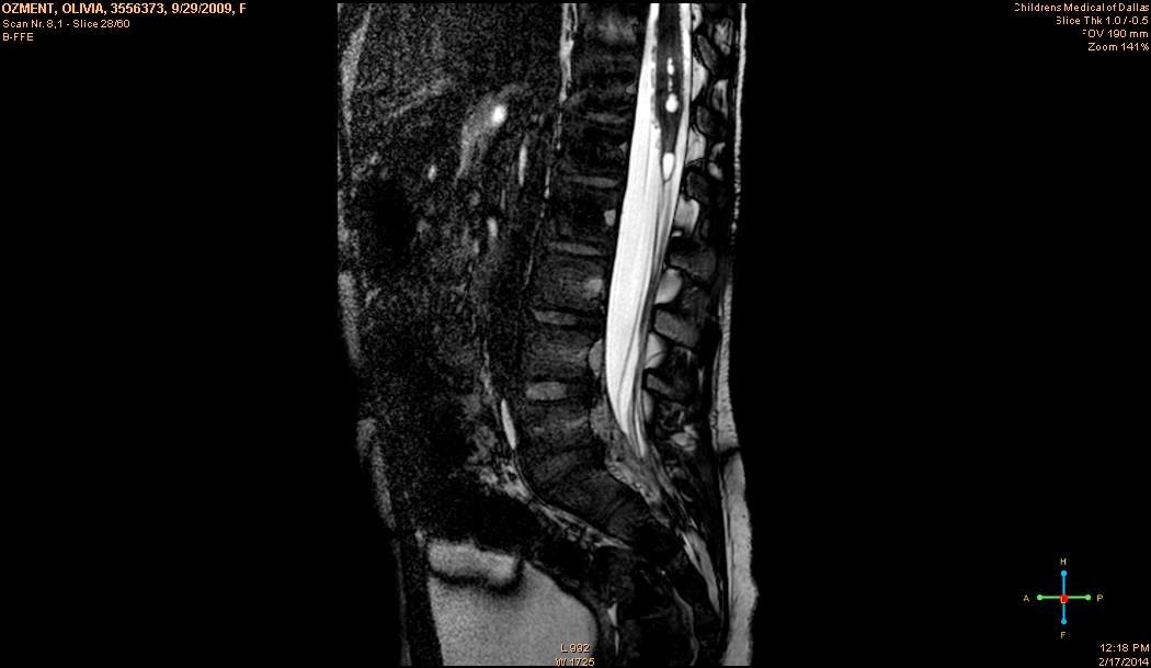 Children's Chiari Journal: CSF Flow Study part 1