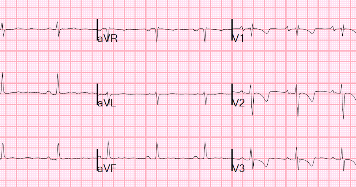 Dr. Smith's ECG Blog: A 30-something woman with chest pain and h/o ...