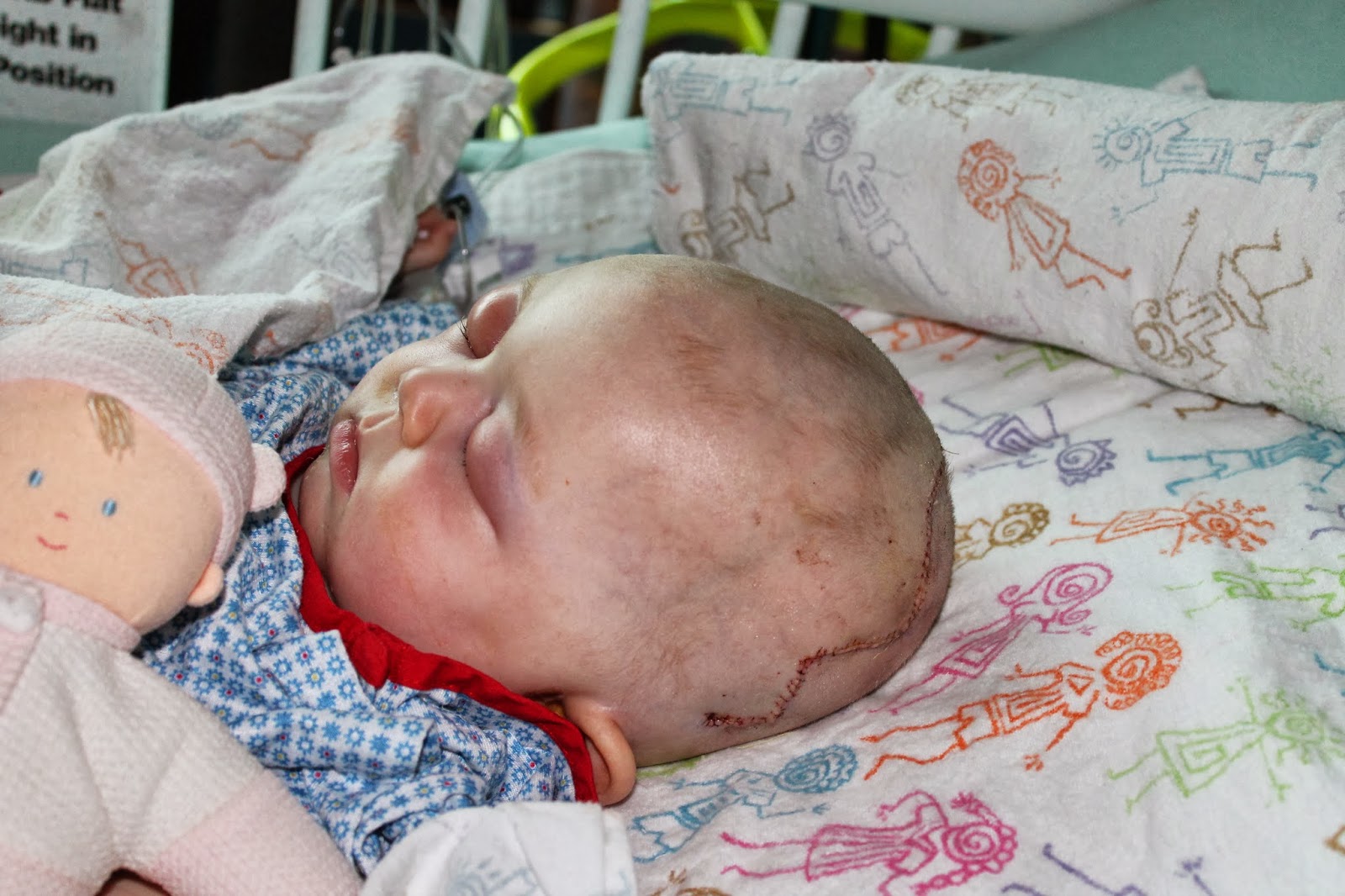 Leah's Right Coronal Craniosynostosis: Distractor Turning