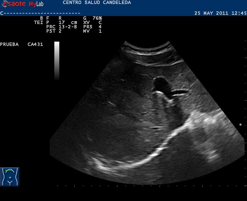 EcoCyl-Grupo: Imagen anecoica hepática (I)