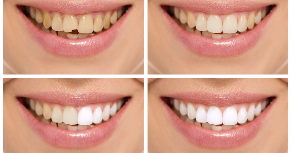 Rodney Raanan: Rodney Raanan - Five Questions to Ask Your Cosmetic Dentist