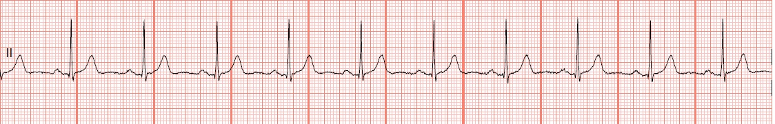 EKG Rhythm Strip Quiz 35