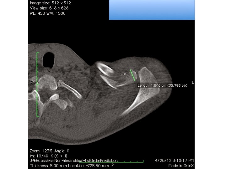 Shoulder and Elbow Surgery: Distal clavicle fracture fixation using ...