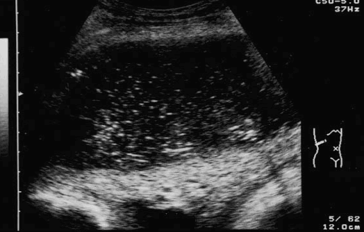 Hydro-Point: Ultrasound sign of air-fluid level in the pleura