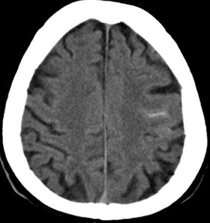 sentinel bleed - meddic