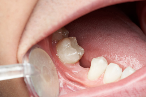 Management of tooth avulsion