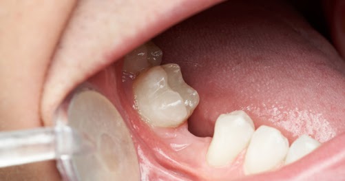 Management of tooth avulsion