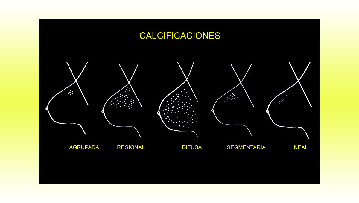 Calcificaciones en los senos: ¿es el principio de cáncer de mama ...