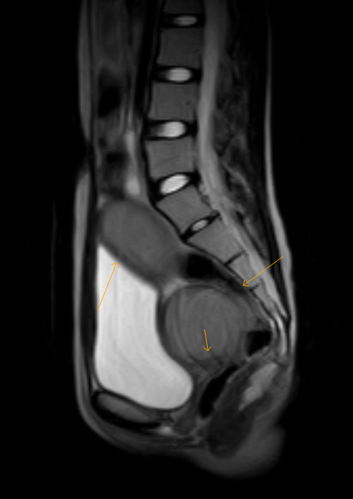 Haematometra & Hematosalpix-MRI - Sumer's Radiology Blog